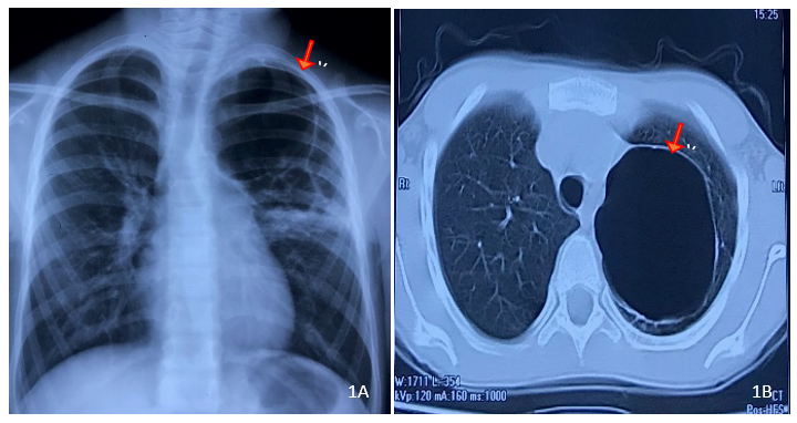 Mucormicosis pulmonar no asociada a inmunodepresión en paciente ...