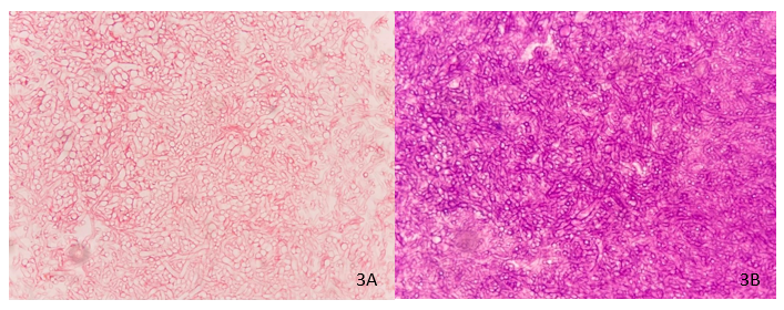 Mucormicosis pulmonar no asociada a inmunodepresión en paciente ...