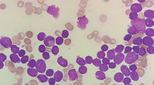 Paraparesia Flácida Subaguda Progresiva Y Meningitis Carcinomatosa Como ...