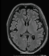 Paraparesia Flácida Subaguda Progresiva Y Meningitis Carcinomatosa Como ...