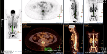 Paraparesia Flácida Subaguda Progresiva Y Meningitis Carcinomatosa Como ...